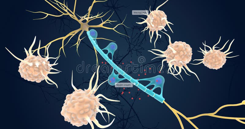 Autoimmune Attack on Myelin Sheath Stock Illustration - Illustration of ...