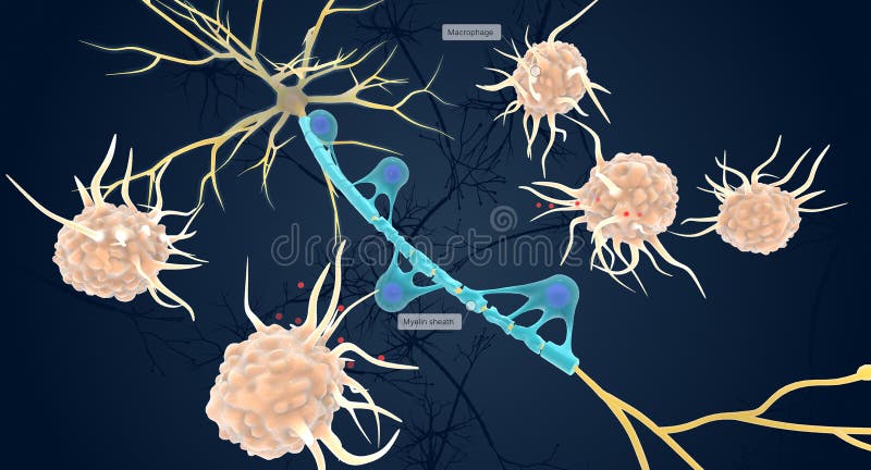 Autoimmune Attack on Myelin Sheath Stock Illustration - Illustration of ...