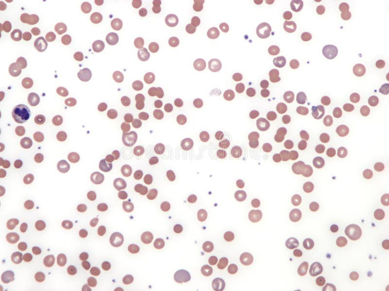 Autoimmune Hemolytic Anemia. Stock Photo - Image of autoimmune ...