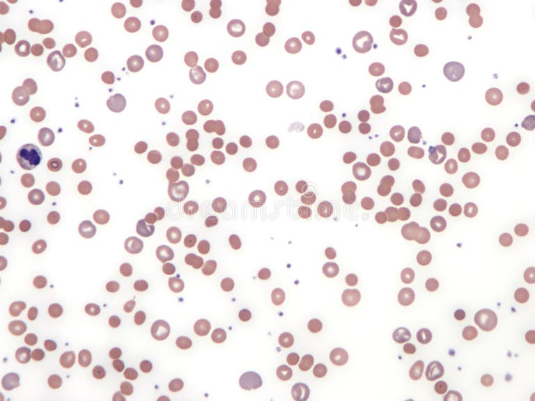 Autoimmune Hemolytic Anemia. Stock Photo - Image of autoimmune ...