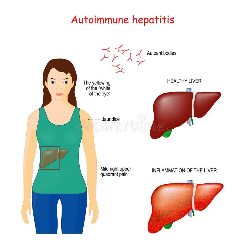 Autoimmune Hepatitis Vector Illustration. Labeled Diagram with Disease ...