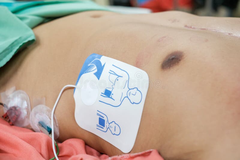 Automated External Defibrillator with Pads on Display. Stock Photo ...