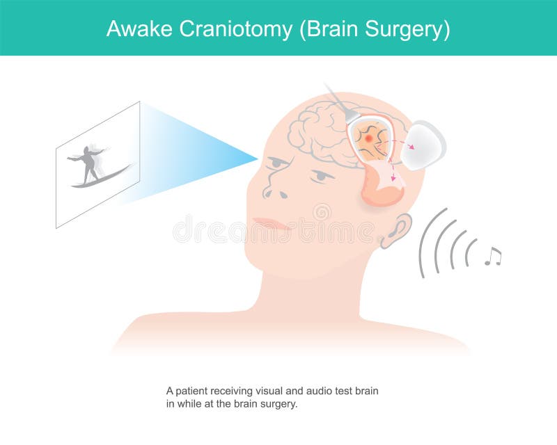 Awake Craniotomy Stock Illustrations – 1 Awake Craniotomy Stock ...