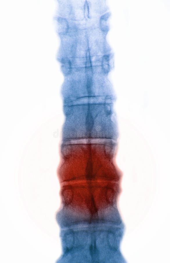 1,064 Paraliżuje zdjęć stockowych - bezpłatne i z licencją Royalty Free ...