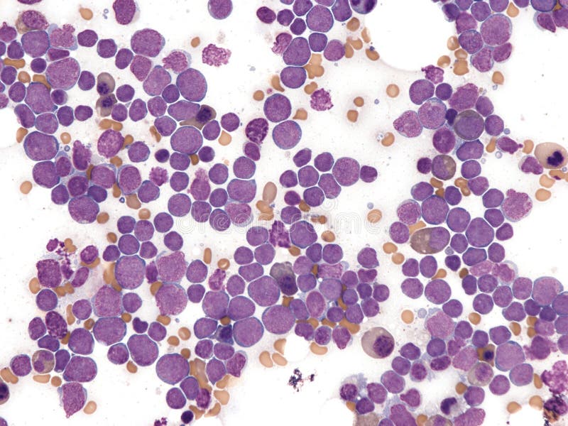 B-cell Acute Lymphoblastic Leukemia in Bone Marrow. Stock Photo - Image ...