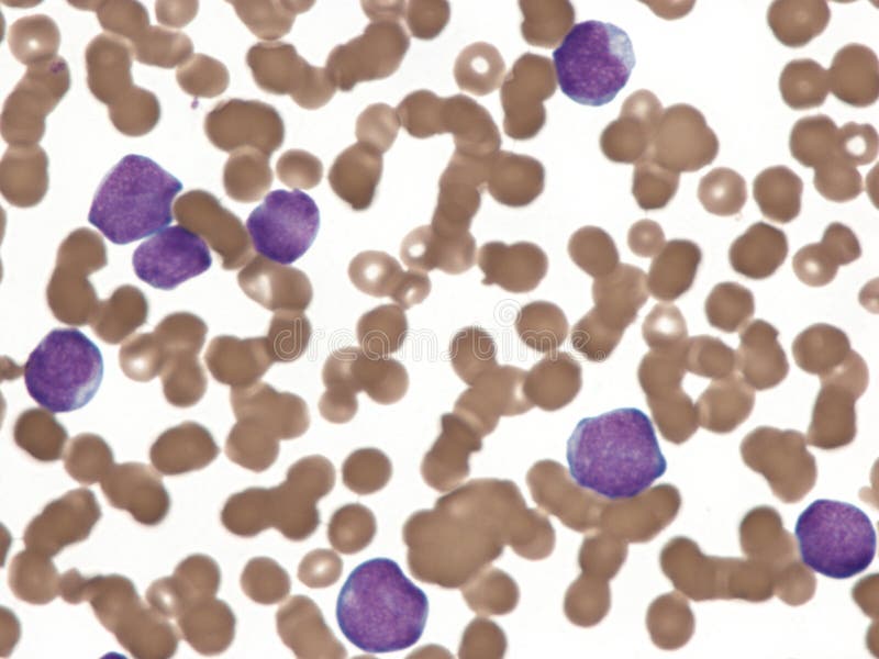 Acute Leukemia, ALL(Acute Lymphoblastic Leukemia), Peripheral Blood ...