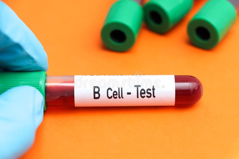 B Cell Test, Blood Sample To Analyze in the Laboratory Stock Image ...