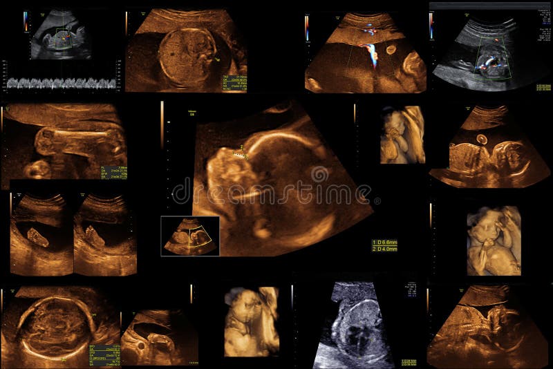 Baby Auf Dem Ultraschallbild Stockfoto - Bild von kopf, bauch: 32149548