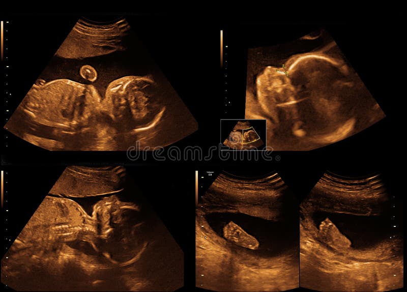 Baby Auf Dem Ultraschallbild Stockbild - Bild von bauch, medizinisch ...