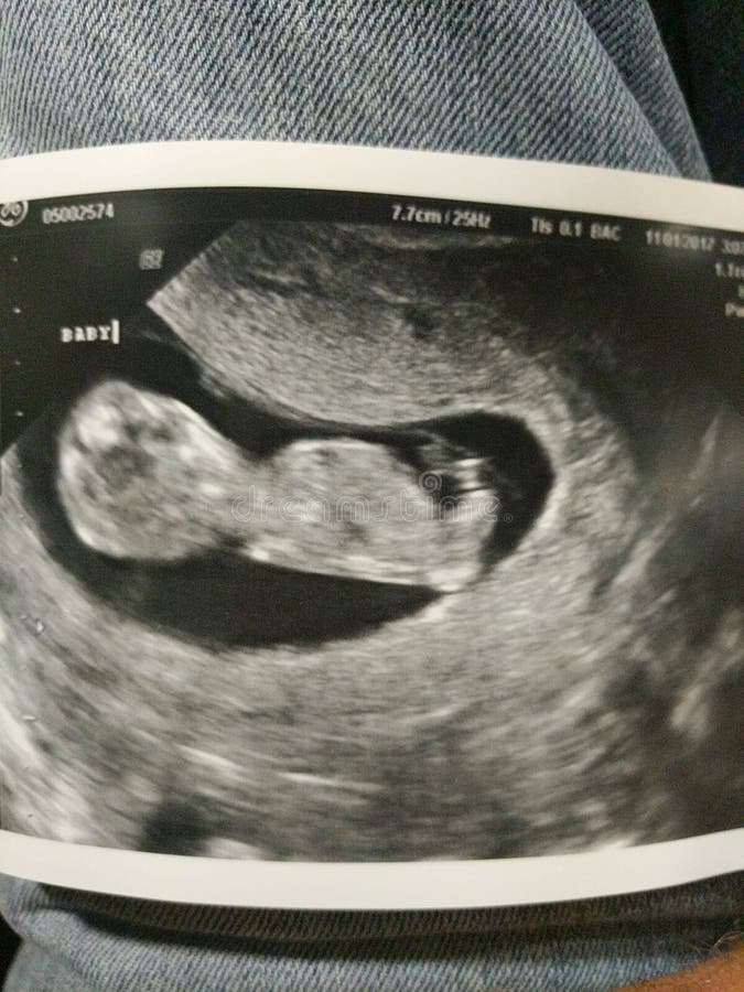 Sonogram stock photo. Image of sonogram, black, baby - 110260442