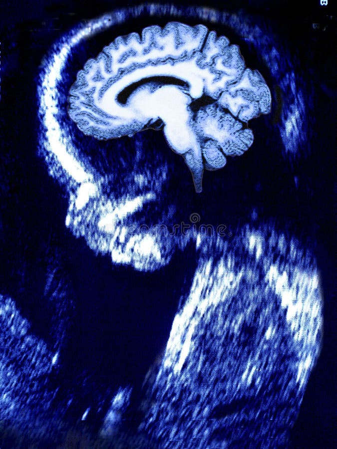 Baby Brain Ultrasound CT Scan Stock Image - Image of memories, medical ... Baby Brain Ultrasound CT Scan Stock Image - Image of memories, medical ...