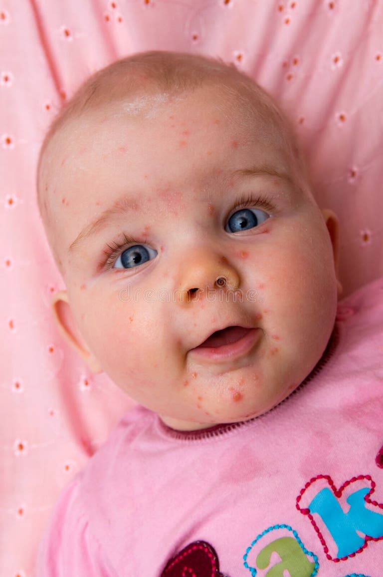 2,171 Chicken Pox Stock Photos - Free & Royalty-Free Stock Photos from ...