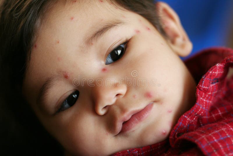 Baby with Chicken Pox stock image. Image of health, contagious - 2848125