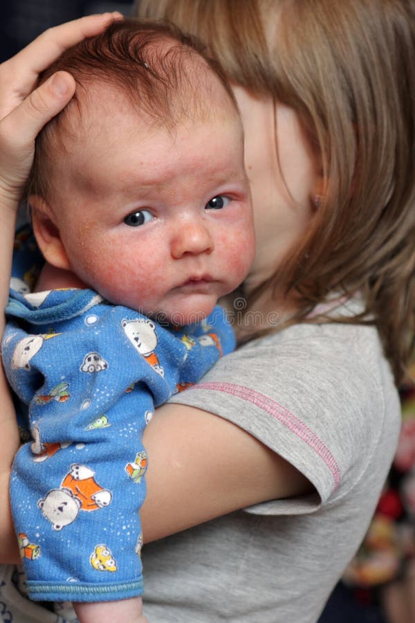 Baby Met Eczeem Op Het Gezicht Stock Afbeelding - Image of weinig ...