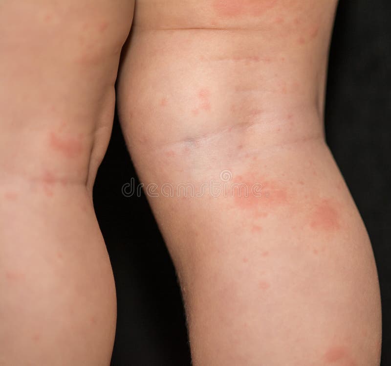 Baby with a rash stock photo. Image of babies, combing - 101653996