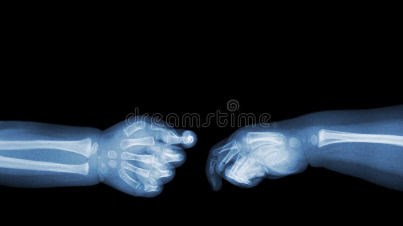 Baby `s Hands X-ray and Blank Area at Upper Side . Shake Hands Stock ...