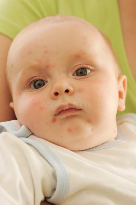 Baby with smallpox stock image. Image of skin, person - 24723813