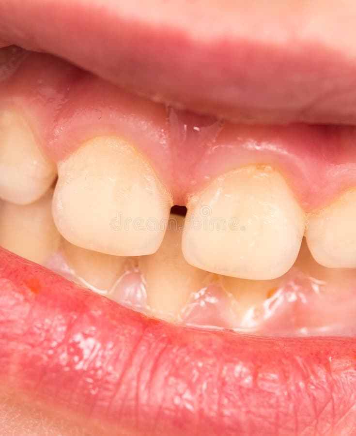 Baby teeth in the mouth stock photo. Image of inside - 106833122