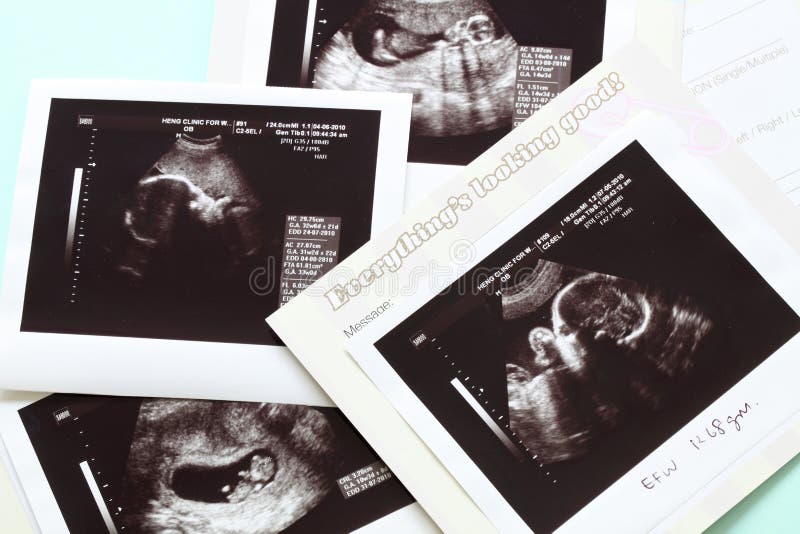 Ultrasound Scan of 10 Weeks Old Twins Stock Photo - Image of women ...