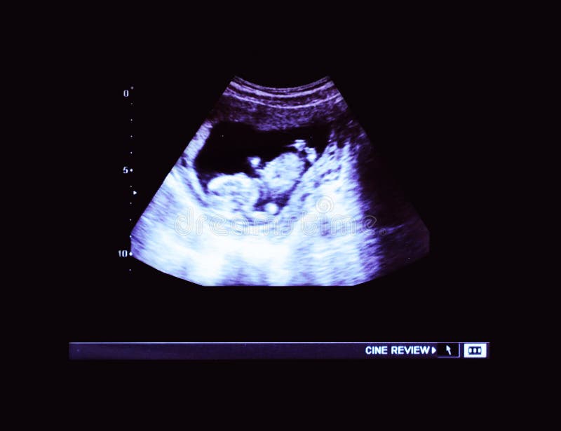 Ultrasound Scan One Month stock image. Image of pregnancy - 5922863