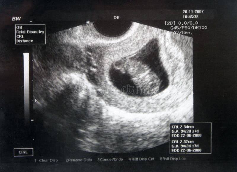 Baby - ultrasound stock photo. Image of health, imaging - 5295898