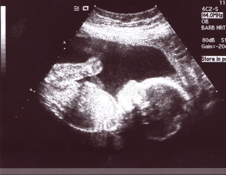 Baby ultrasound stock image. Image of medicine, female - 5872813