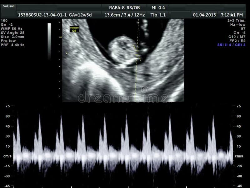 4D Baby ultrasound scan stock video. Video of prenatal - 92848273