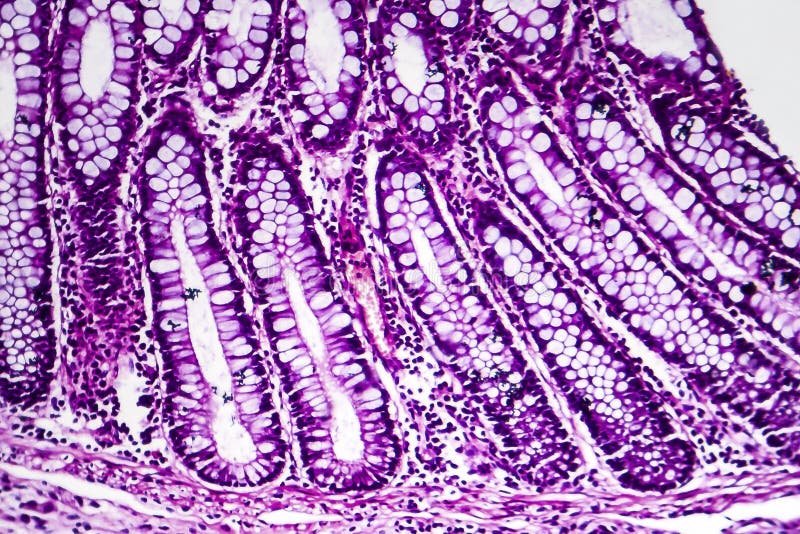 Bacillary Dysentery, Light Micrograph Stock Photo - Image of histology ...