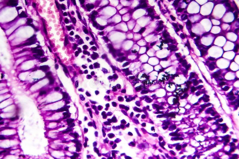 Bacillary Dysentery, Light Micrograph Stock Photo - Image of infiltrate ...