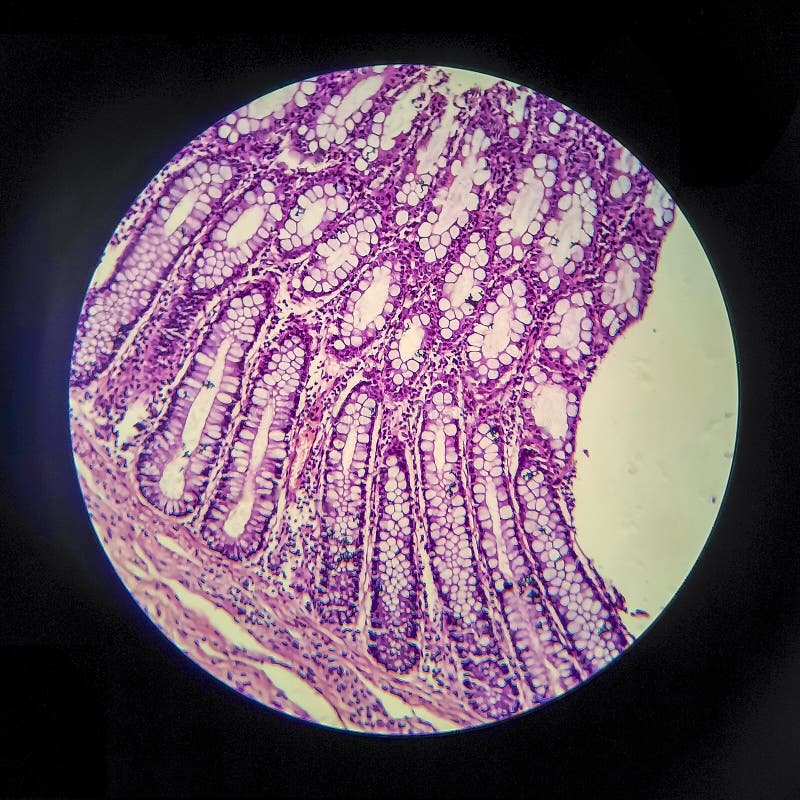 Bacillary Dysentery, Light Micrograph Stock Image - Image of bacterium ...