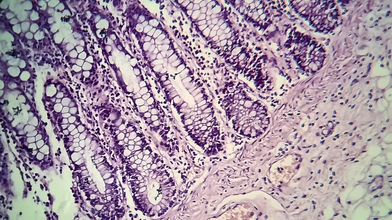 Bacillary Dysentery, Light Micrograph Stock Image - Image of high ...