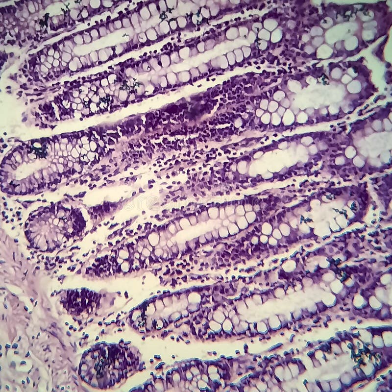 Bacillary Dysentery, Light Micrograph Stock Image - Image of stain ...