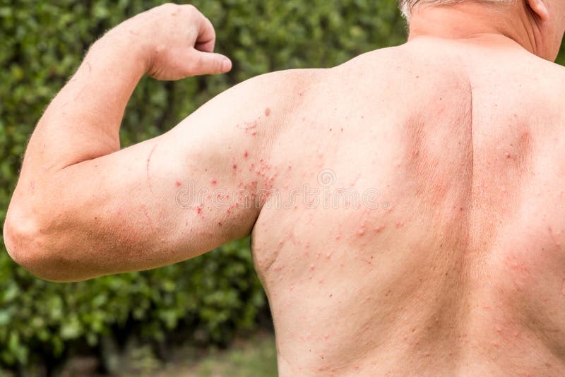 Back and Arms of Man with Rash on, Symptoms of Itching, Skin Allergy ...