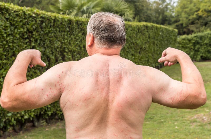 Back and Arms of Man with Rash on, Symptoms of Itching, Skin Allergy ...