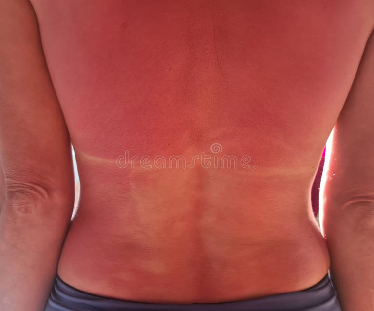Back Burn by Sunbeams and Red Skin Stock Photo - Image of fried, body ...