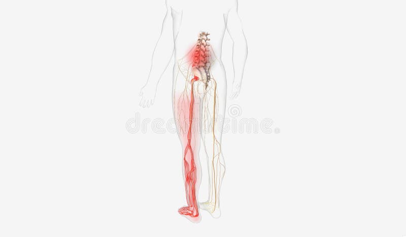 Back and Lower Limb Pain stock illustration. Illustration of body ...