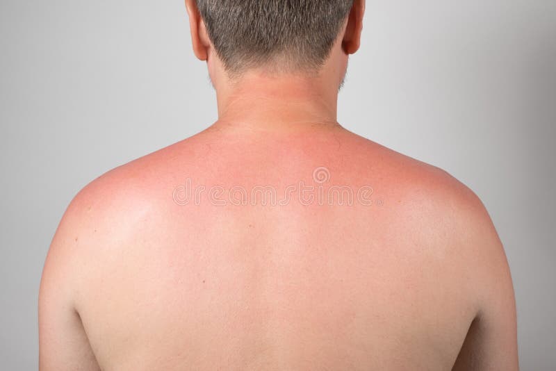Back of a Man with a Sunburn, Close-up. Stock Photo - Image of health ...