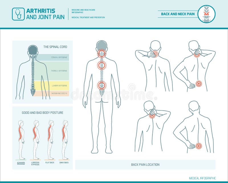 Back pain infographic stock vector. Illustration of kyphosis - 90415406