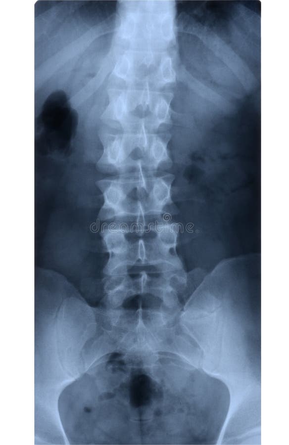 Radiograph Of Human Backbone Stock Image - Image of anatomy, diagnosis ...