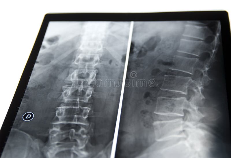X-ray Image and Computer Mouse Stock Photo - Image of spine, exam: 4242824