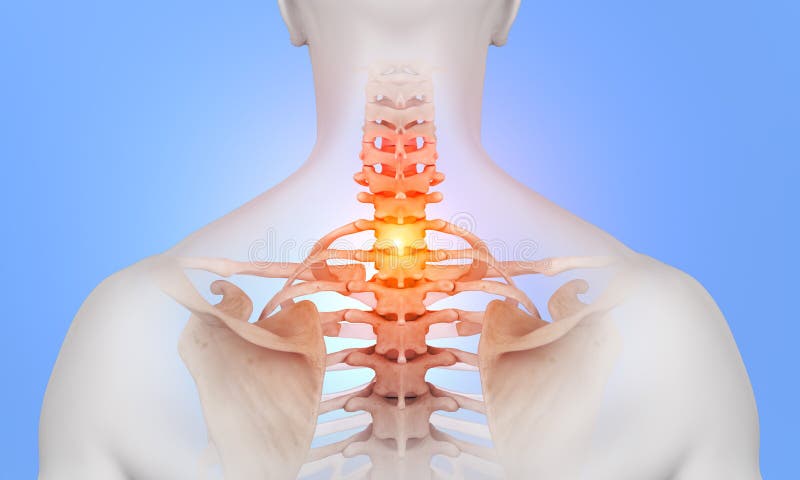 X-ray Cervical Section of the Spine Back View with Injury Stock ...