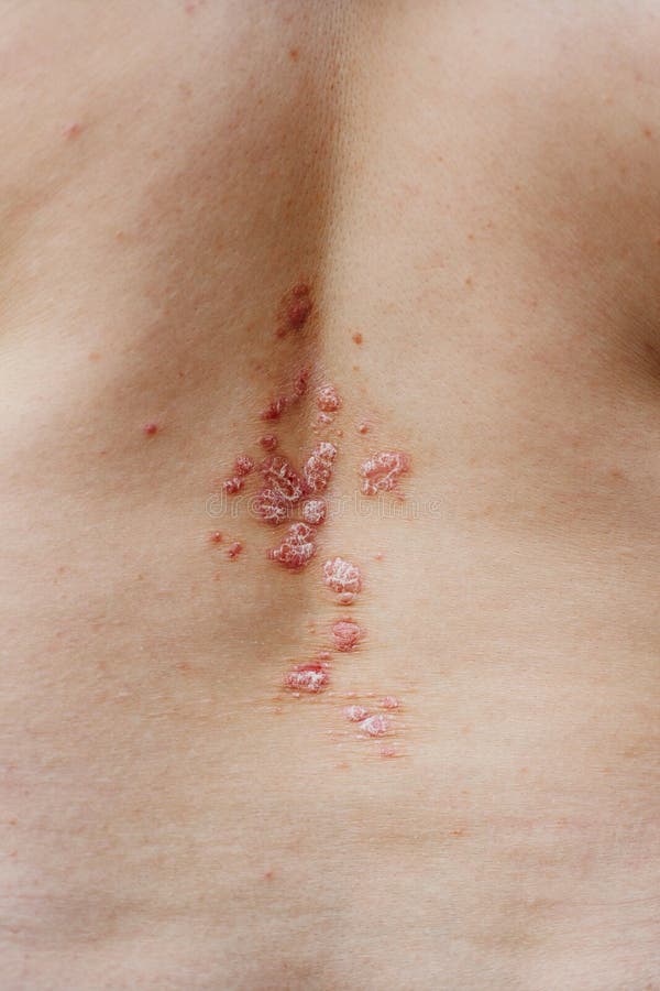 Back View of Woman with Dermatitis Problem of Rash and Itchy Dry Skin ...