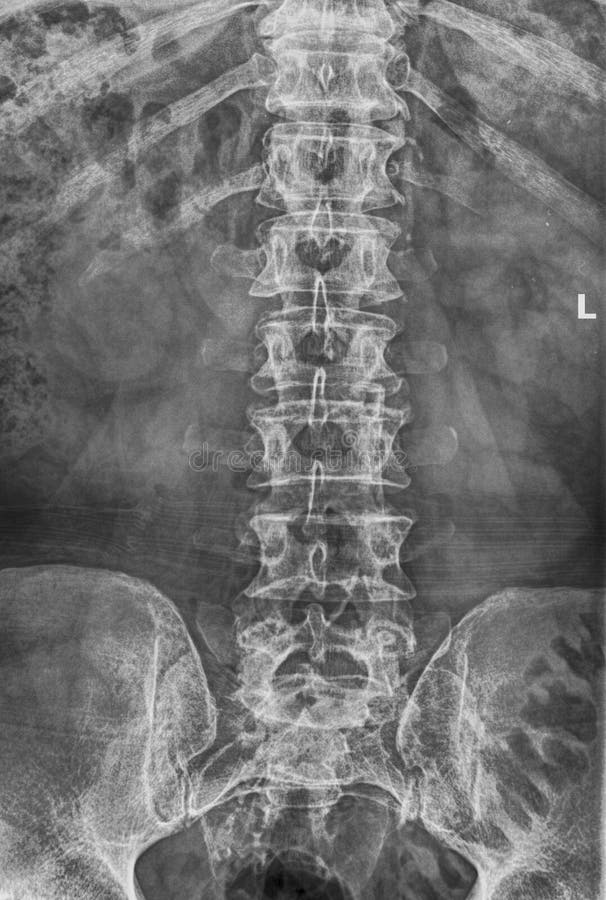 Backbone stock image. Image of pelvis, anatomy, bones - 307452577