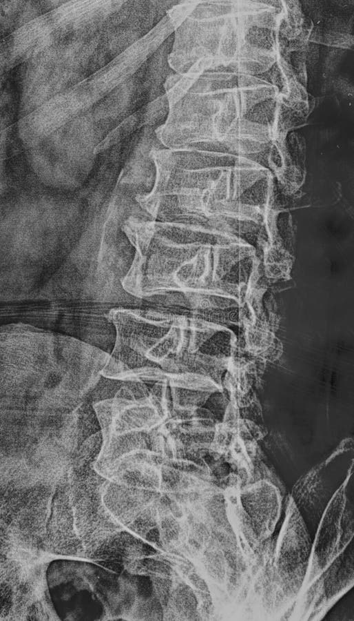 Backbone stock photo. Image of radiology, disease, anatomy - 307452582