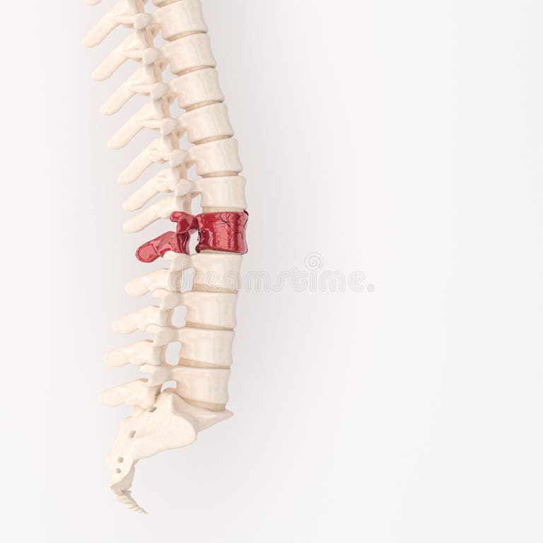 Backbone with Red Fragmented Vertebrae Stock Illustration ...