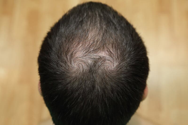 Balding head stock image. Image of improvement, forehead - 5300257