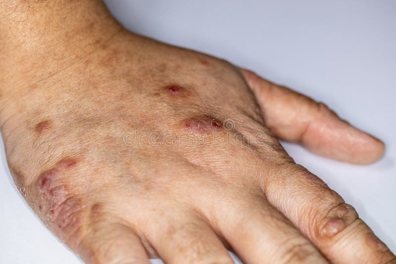 Background of Human Skin with Dust Mite Allergy. Stock Image - Image of ...