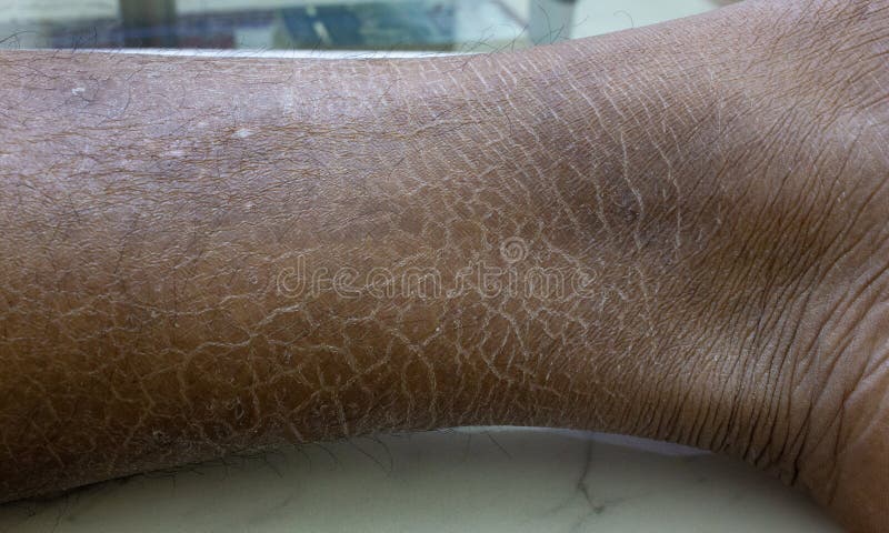 Shedding Skin Human Stock Photos - Free & Royalty-Free Stock Photos ...