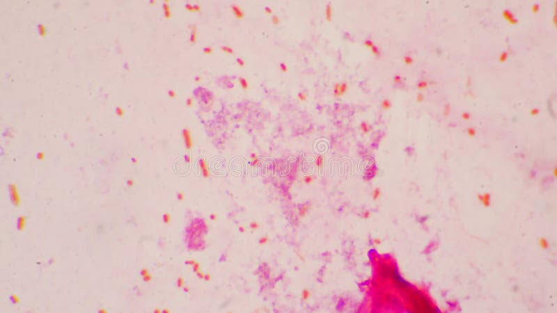 Gram Negative Diplococci In Sputum