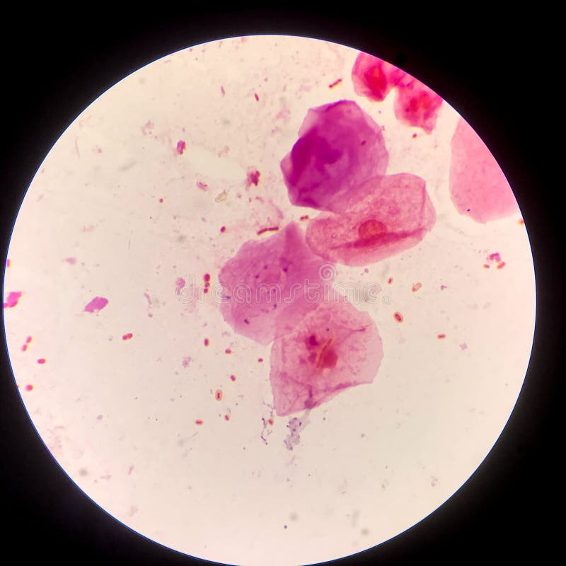 Bacteria Cell Gram Neagative Bacilli with Capsule.Sample Sputum in Gram ...
